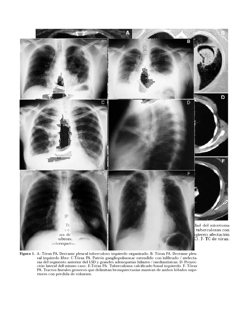 RX NEUMONIA POR TUBERCULOSIS | PDF