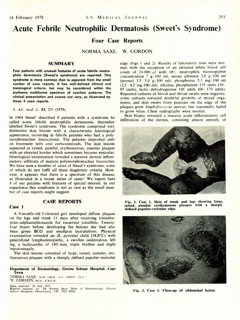 Saxe N Gordon 1978 Acute Febrile Neutrophilic Dermatosis (Sweet S ...