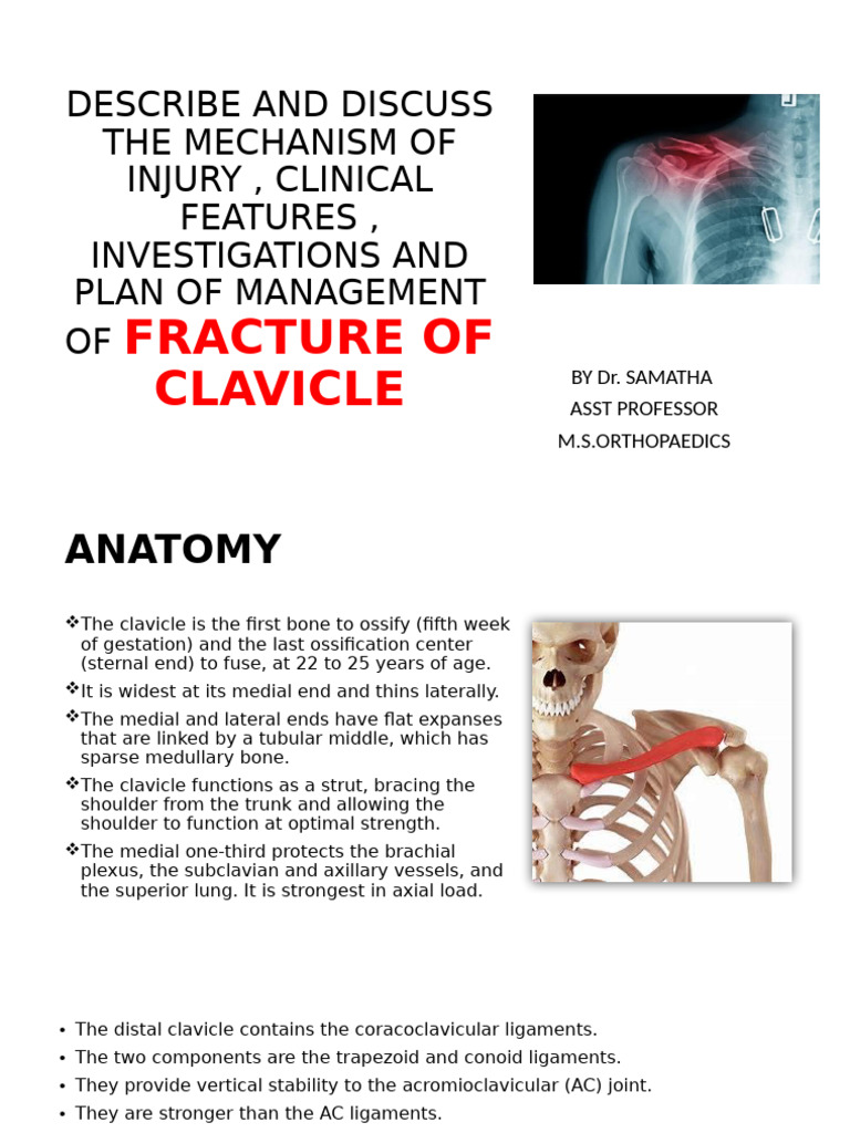Clavicle Fracture@Ortho | PDF | Shoulder | Musculoskeletal System