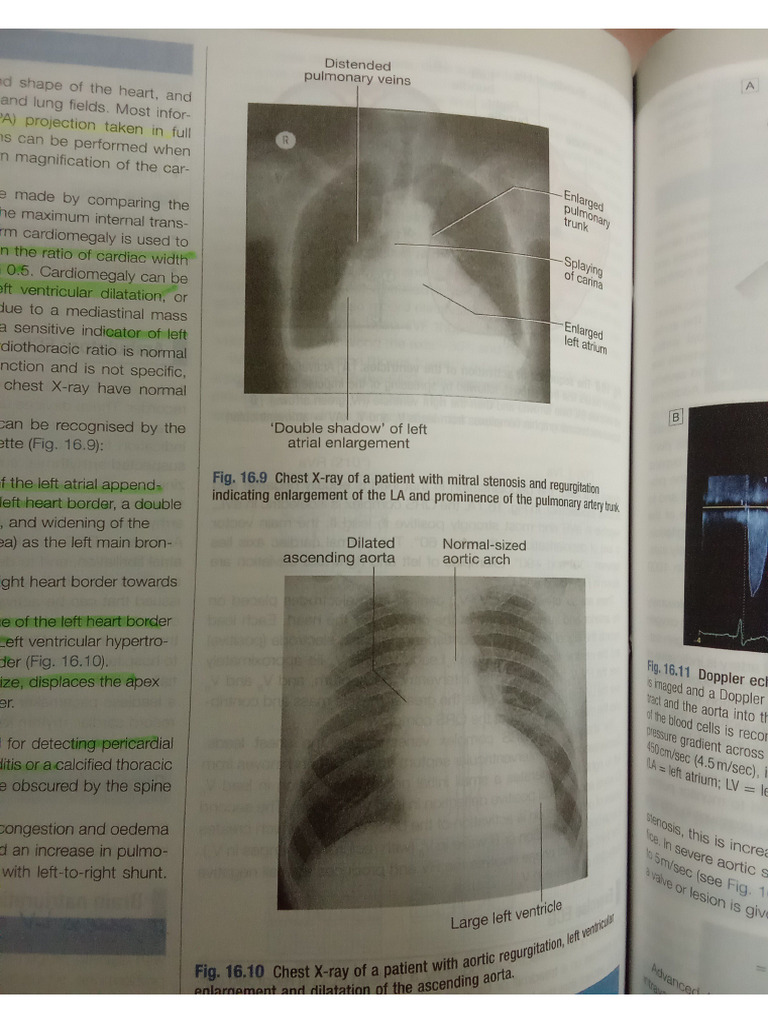 Davidson CXR, ECG, CT Scan | PDF