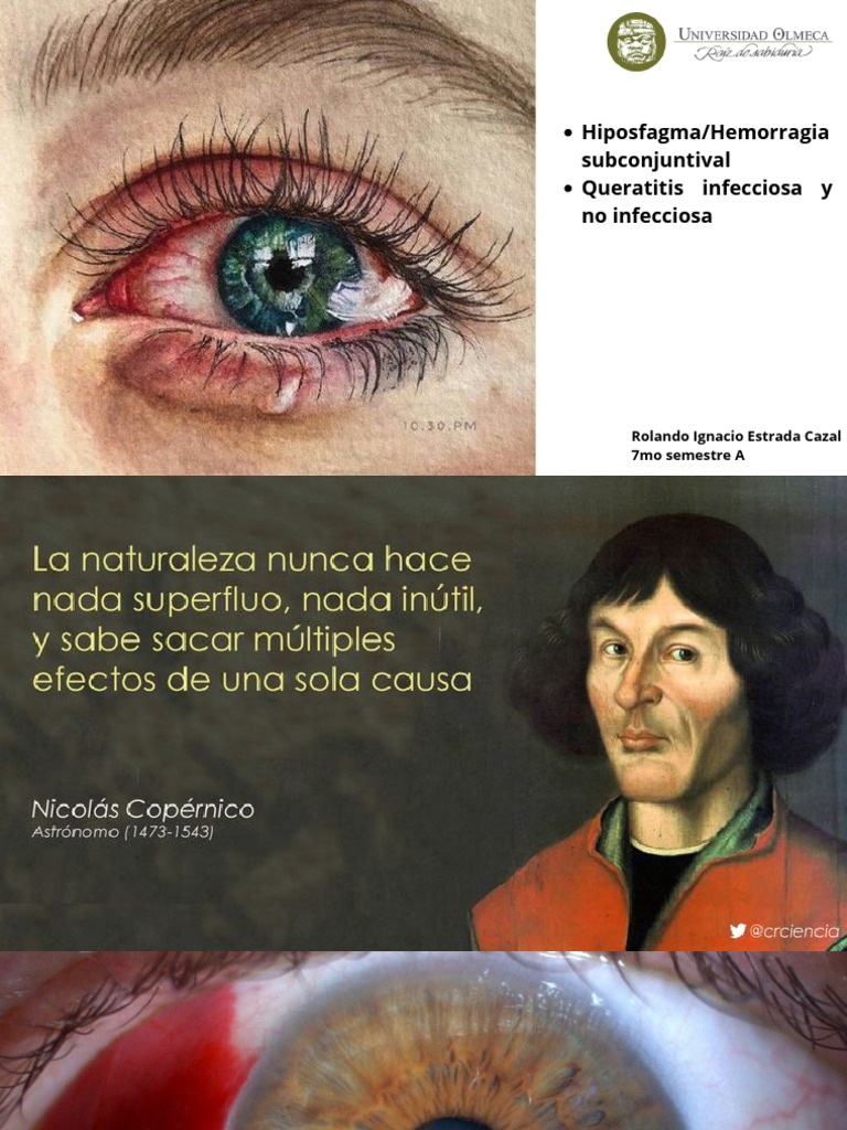 Presentación de Oftalmología Hiposfagma y Queratitis - 20250324 ...