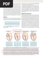 Atrial Fibrillation:Flutter in Pre-Excitation - LITFL - ECG Library ...