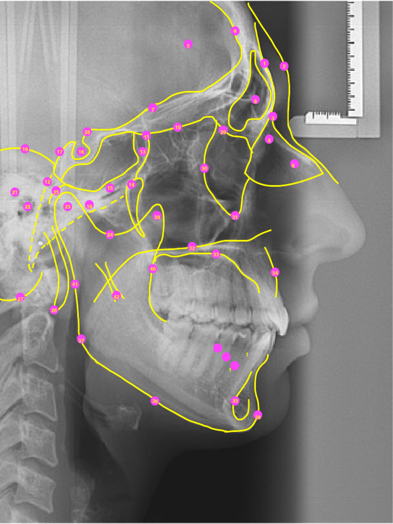 Cephalometric Analysis | PDF