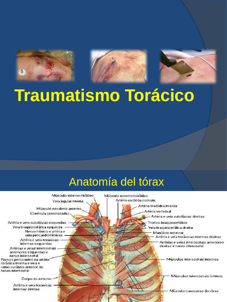TRAUMA DE TORAX | PDF | Tórax | Cirugía