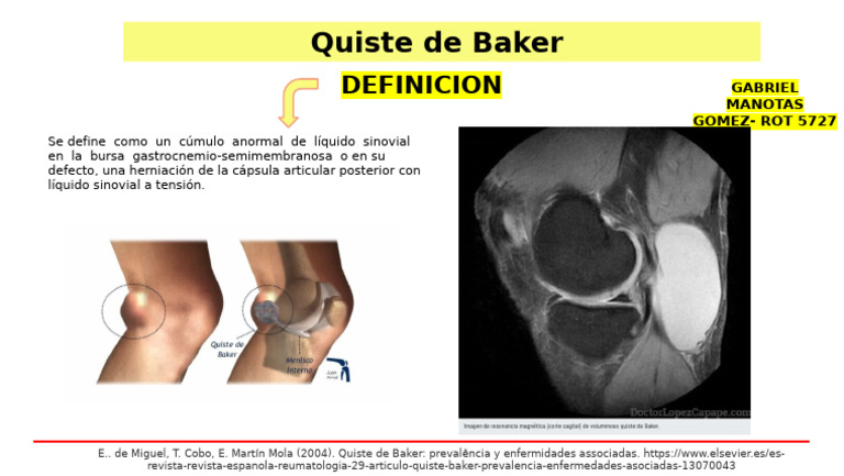 Quiste de Baker | PDF