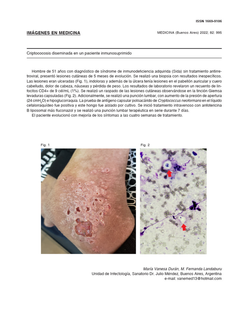 Criptococosis Diseminada en Un Paciente Inmunosuprimido: Imágenes en ...