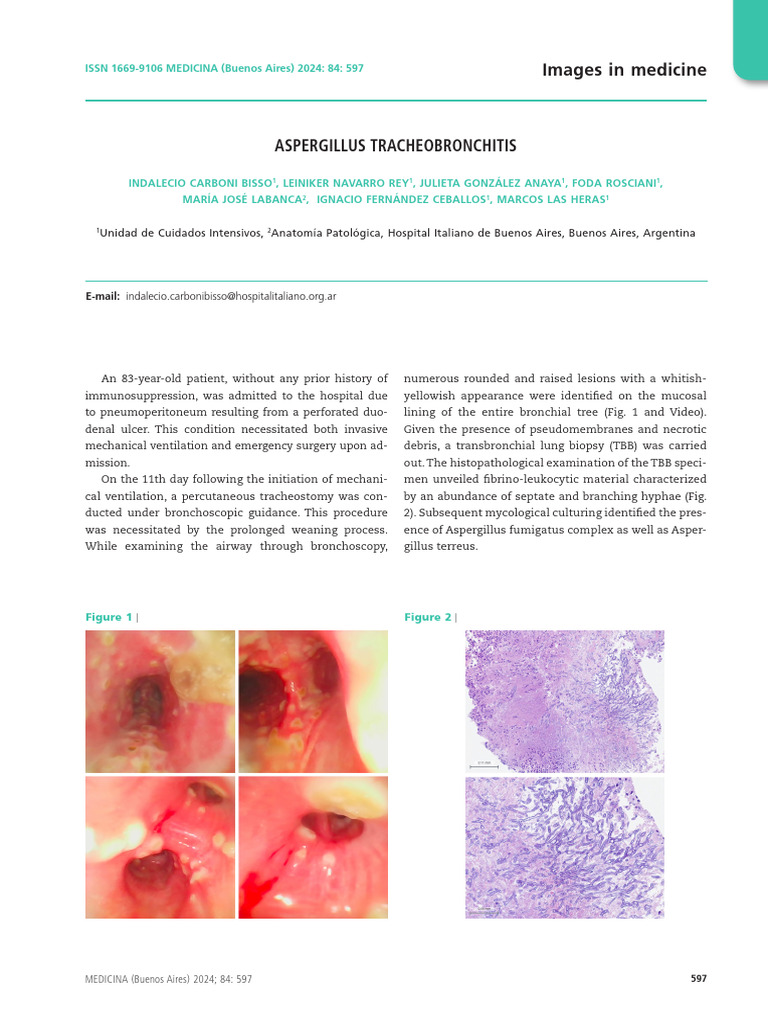 Aspergillus Tracheobronchitis: Images in Medicine | PDF