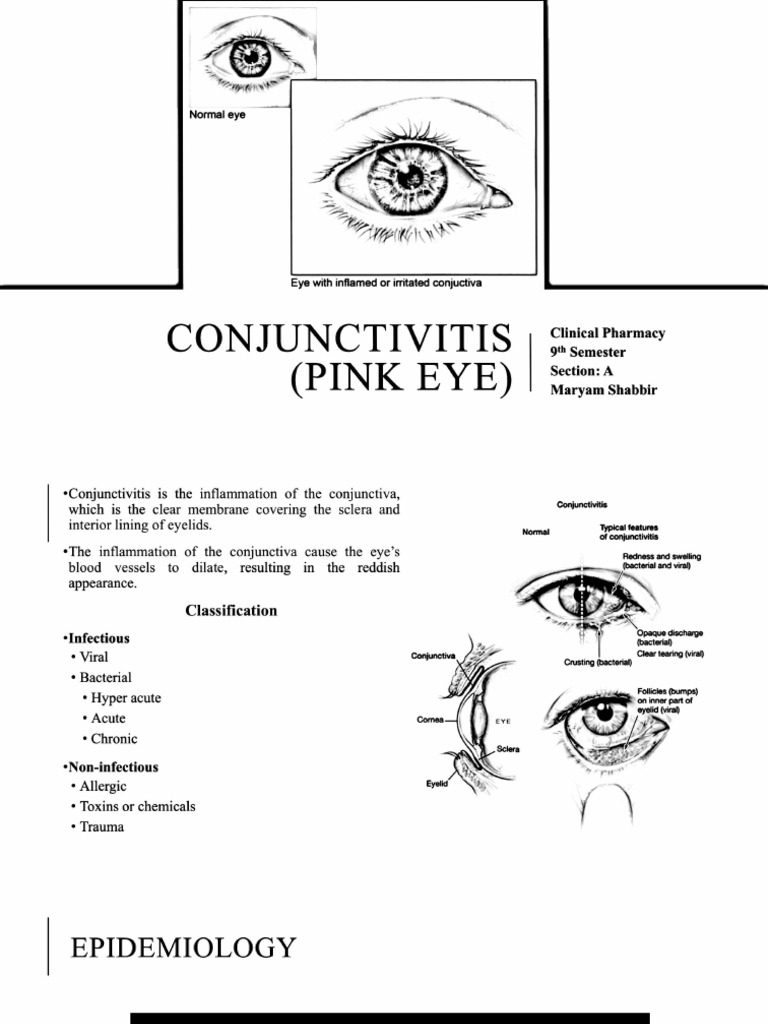 Conjunctivitis (Pink Eye) | PDF