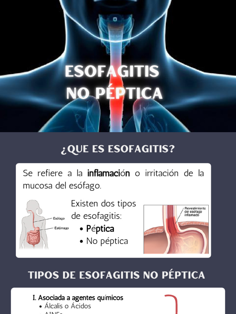 Tipos y síntomas de esofagitis | PDF | La enfermedad por reflujo ...