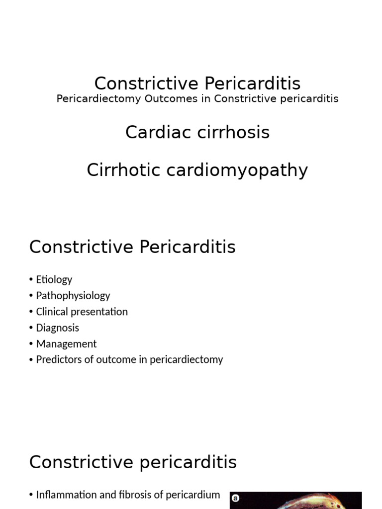 Constrictive Pericarditis | PDF | Heart | Heart Failure
