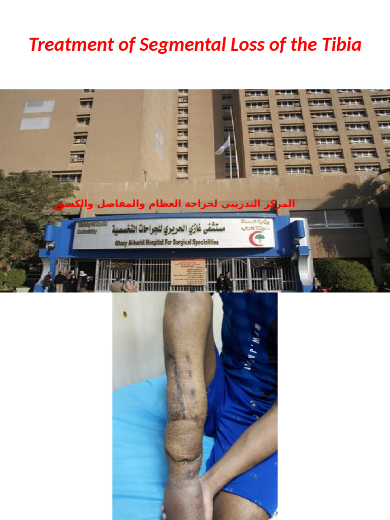 Treatment of Segmental Loss of The Tibia | PDF | Ankle | Bone