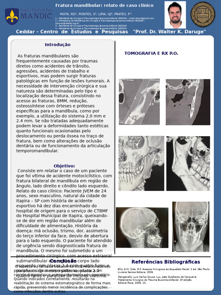 Fratura Mandibular: Tratamento e Sucesso | PDF | Cirurgia ortopédica ...