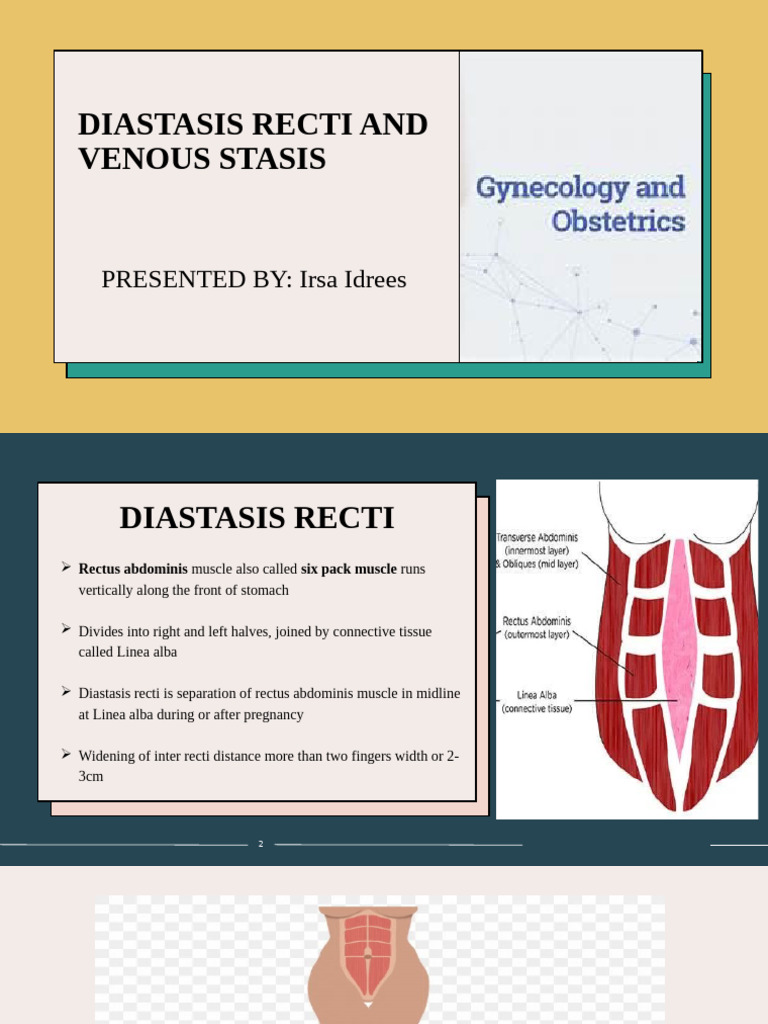 Diastasis Recti and Venous Stasis - 104303 | PDF | Vein | Diseases And ...