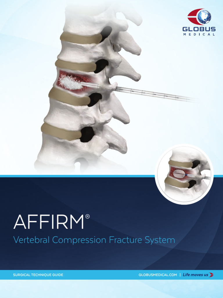 Attgd01 Affirm VCF Techniqueguide Reve | PDF | Syringe | Vertebra