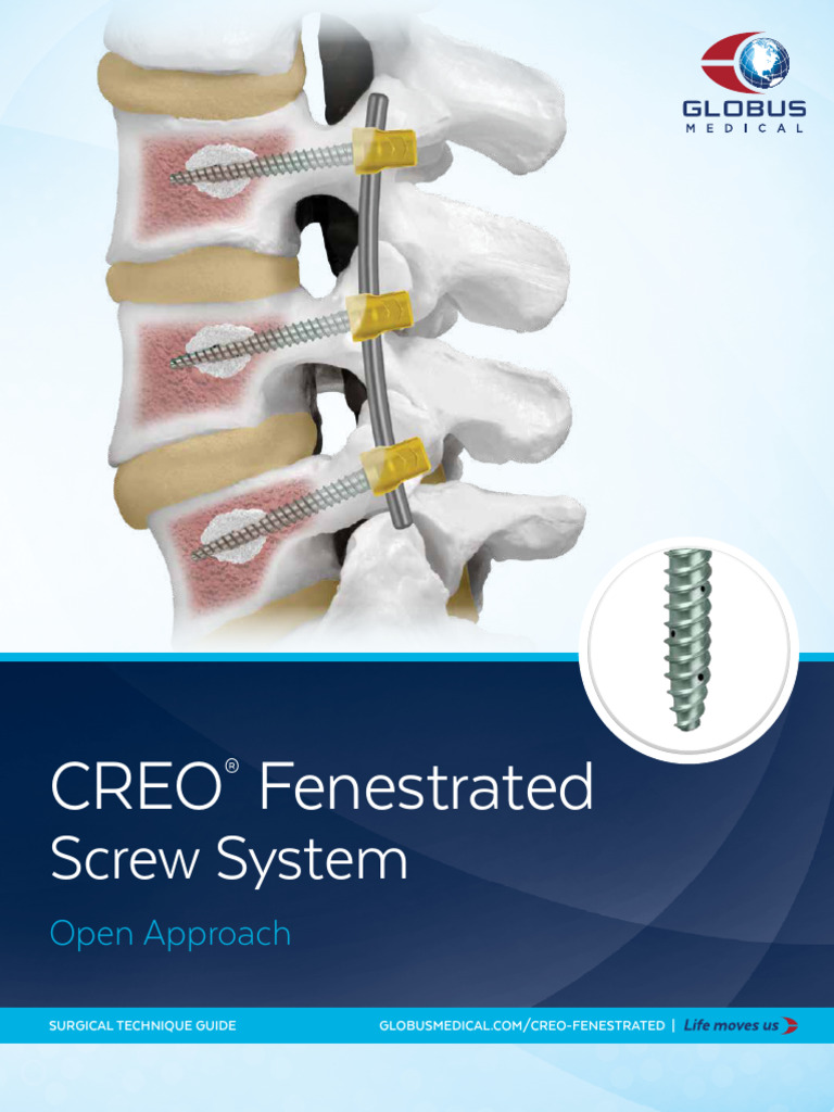 CREO® Fenestrated Screw System Guide | PDF | Screw | Syringe