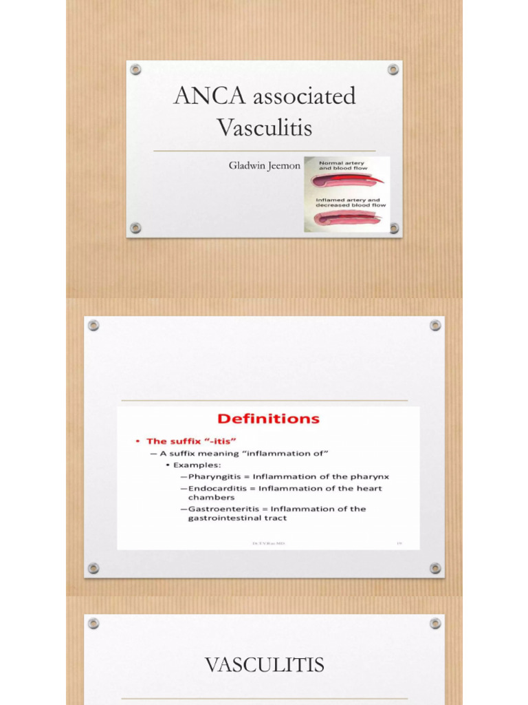 ANCA Associated Vasculitis | PDF