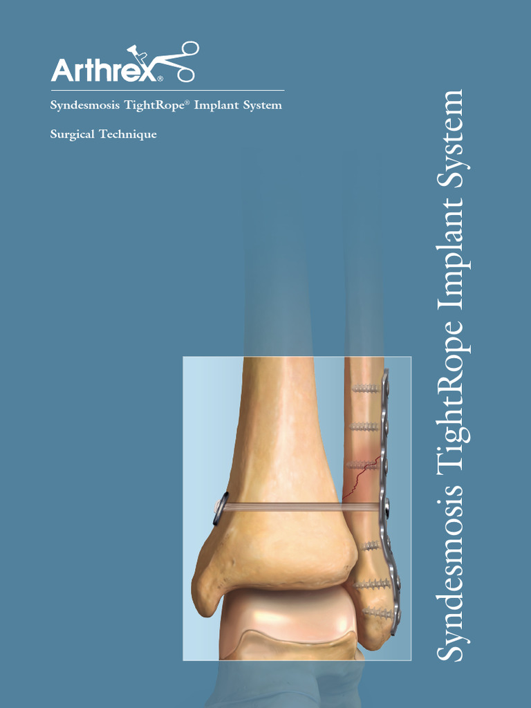 Syndesmosis TightRope Implant Overview | PDF | Ankle | Musculoskeletal ...