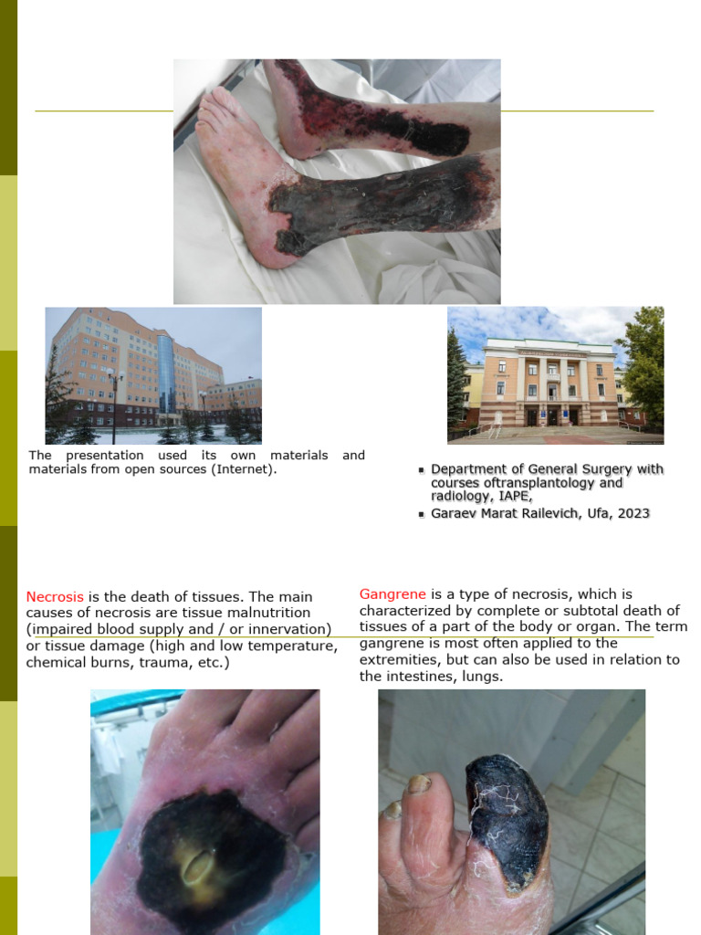 Acute and Chronic Circulatory Disorders. Necrosis, Gangrene, Ulcers ...