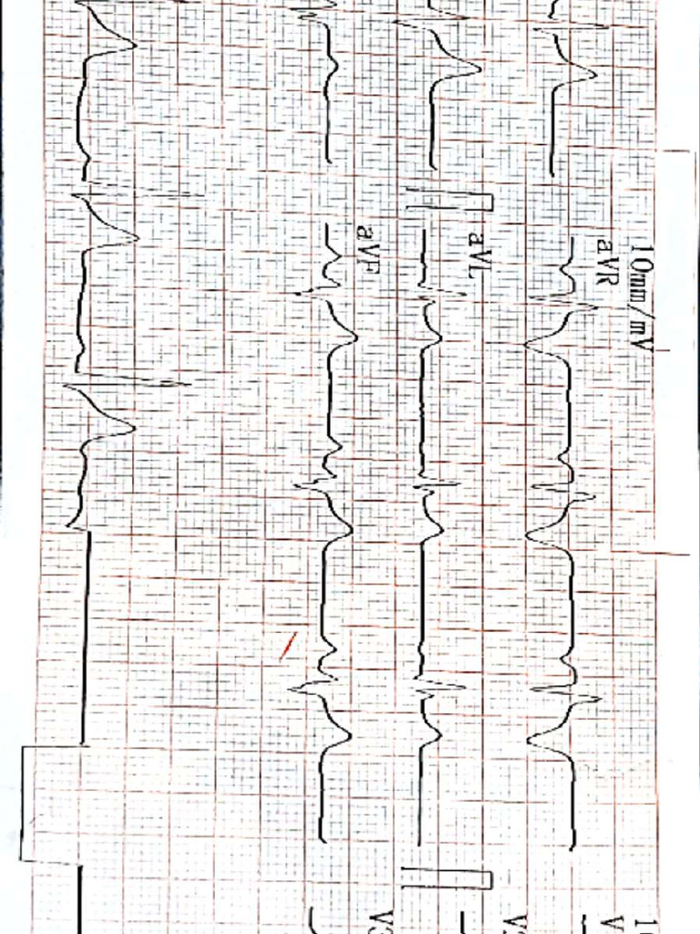 Ecg 2 | PDF