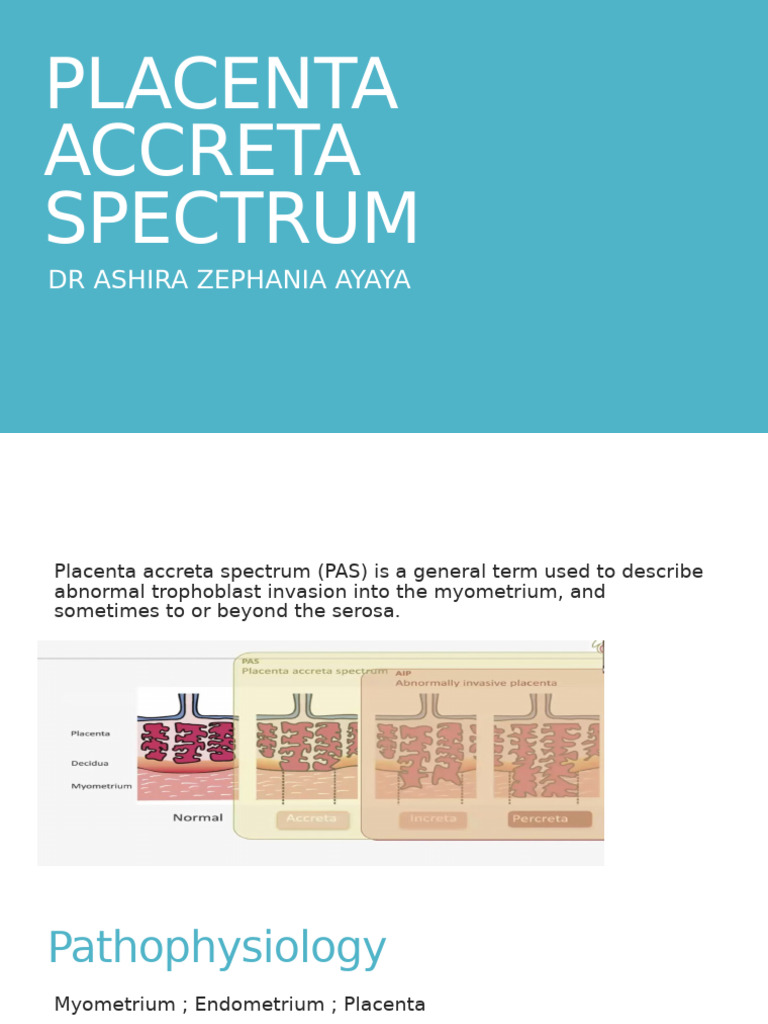 Understanding Placenta Accreta Spectrum | PDF | Placenta | Uterus