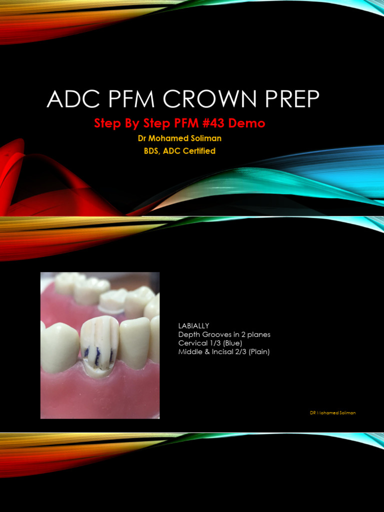ADC PFM Crown Preparation #43 Demo by Mohamed Soliman | PDF | Dentistry ...