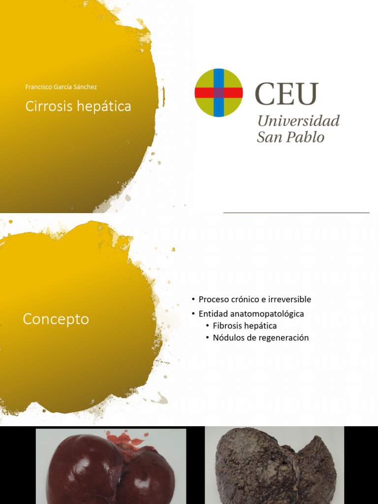 Higado. Cirrosis Hepática | PDF | Cirrosis | Enfermedades y trastornos