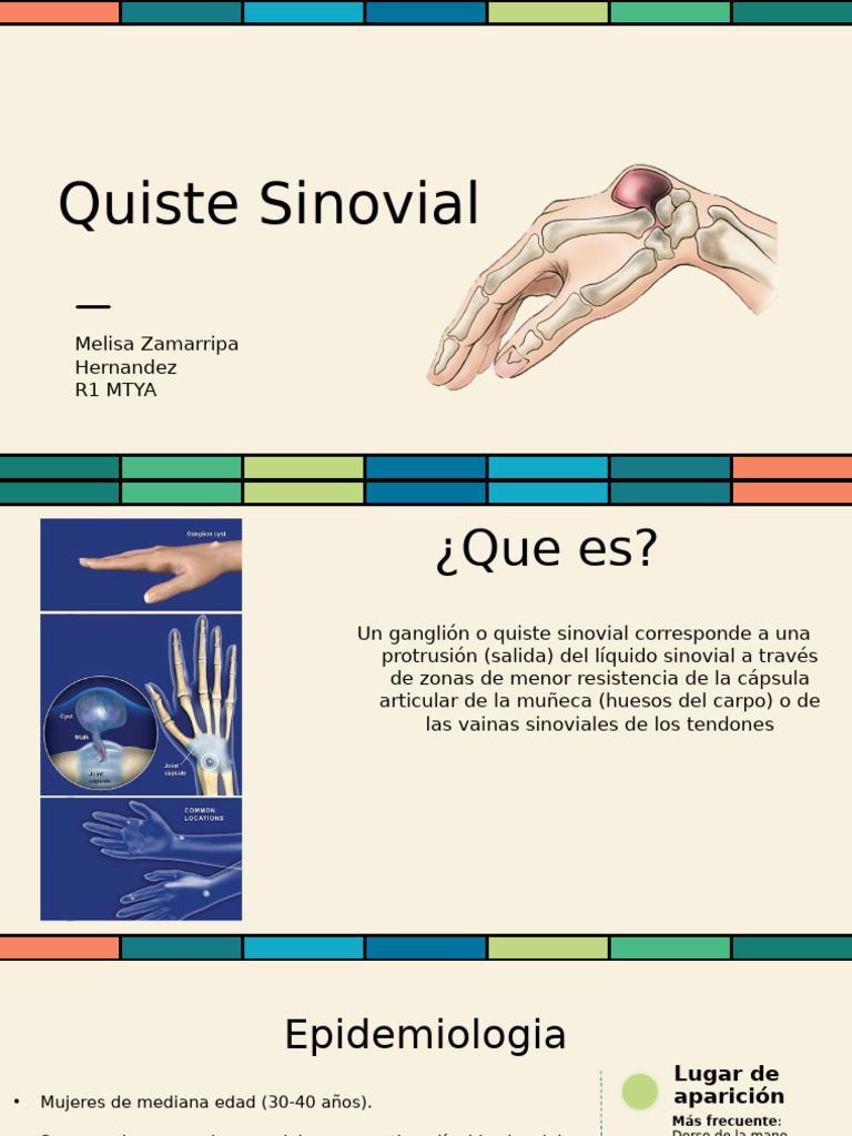 Quiste Sinovial1 | PDF | Mano | Articulación