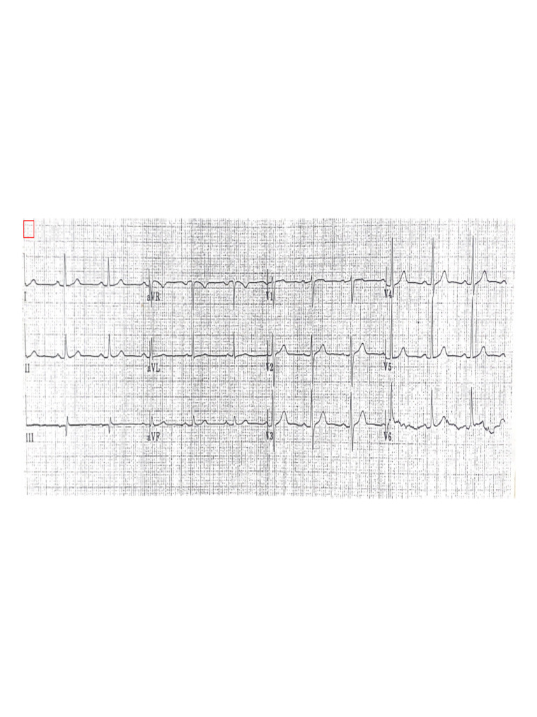 16 Ecg | PDF