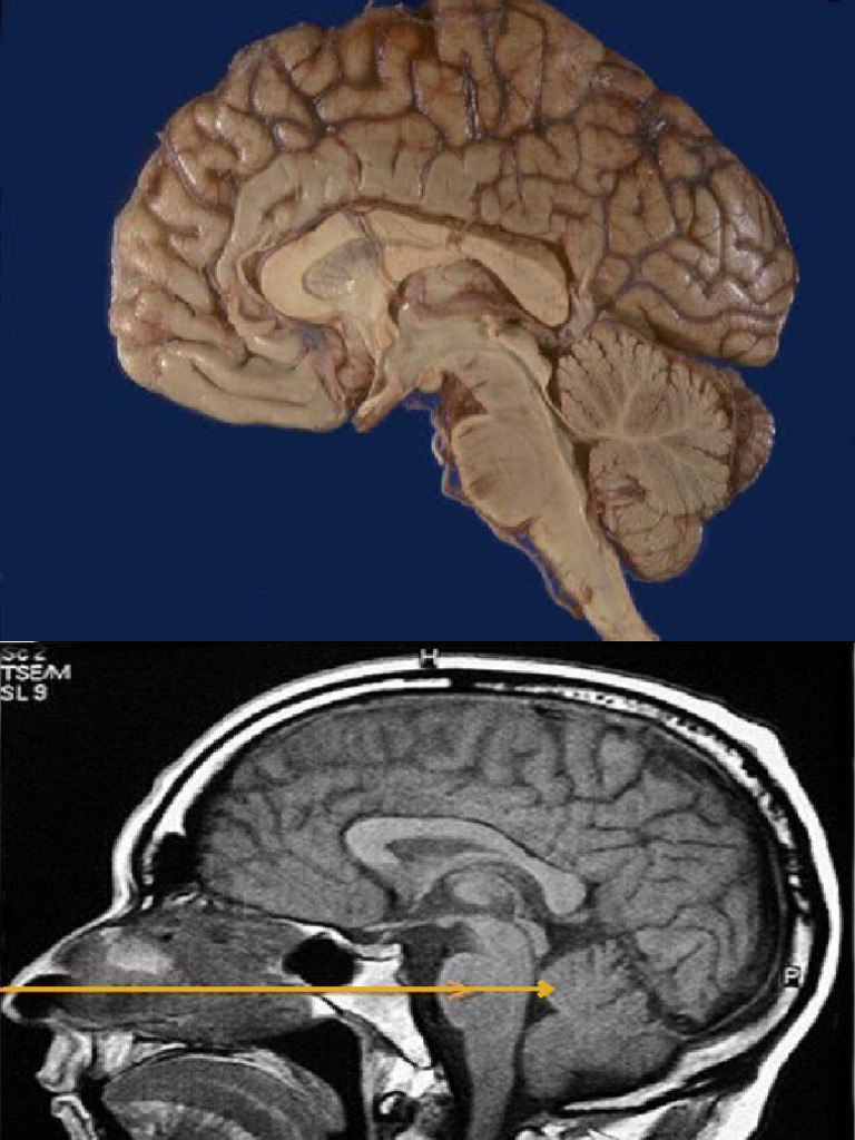 Cerebelo | PDF | Cerebelo | Neuroanatomía