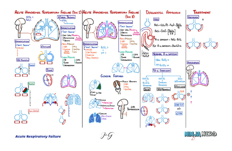 Acute Respiratory Failure Insights | PDF