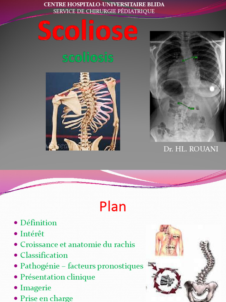 Déviations Rachidiennes Et Scoliose | PDF | Scoliose | Maladies et ...