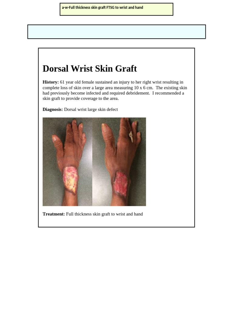 A-W-Full Thickness Skin Graft FTSG To Wrist and Hand | PDF