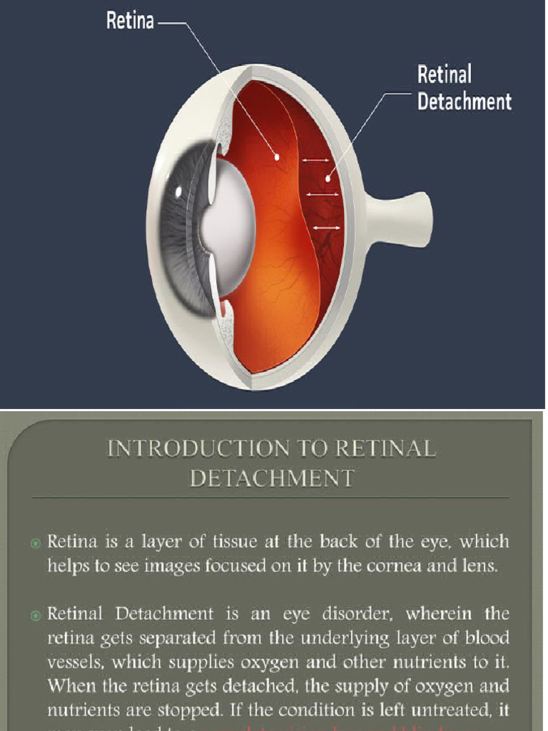 Retina Detachment 12 u | PDF
