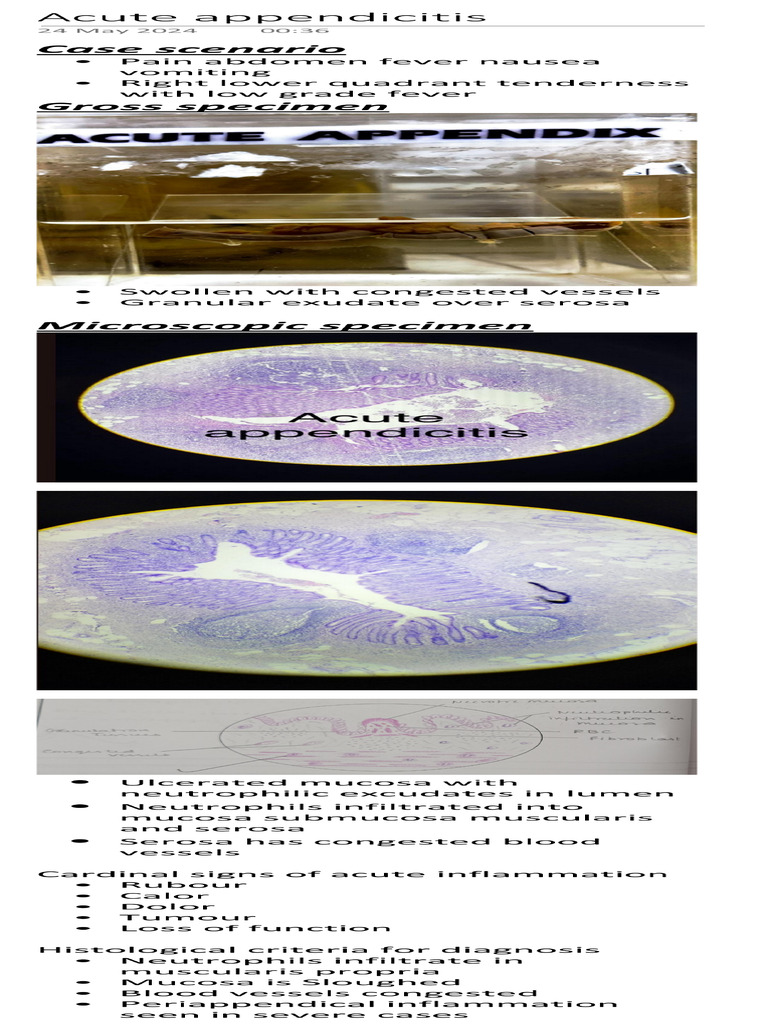 Acute Appendicitis | PDF