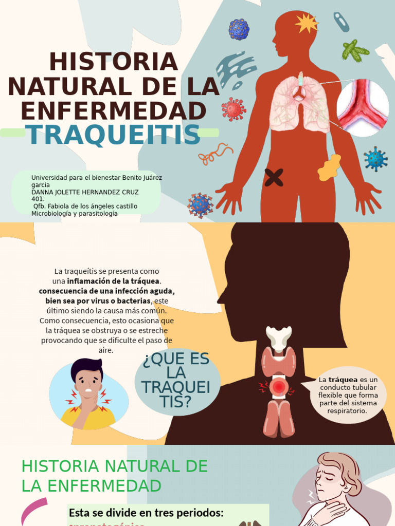 Traqueitis, Danna Jolette-1 | PDF | Influenza | Medicina CLINICA