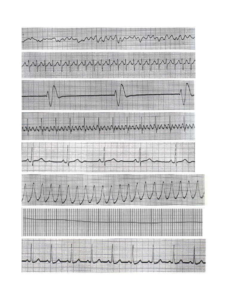 Contoh Gambaran Ekg | PDF