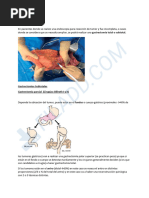 Gastrectomía Parcial | PDF | Estómago | Abdomen