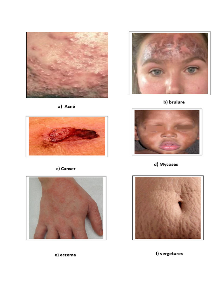 Maladies Dues Au Decapage de La Peau | PDF