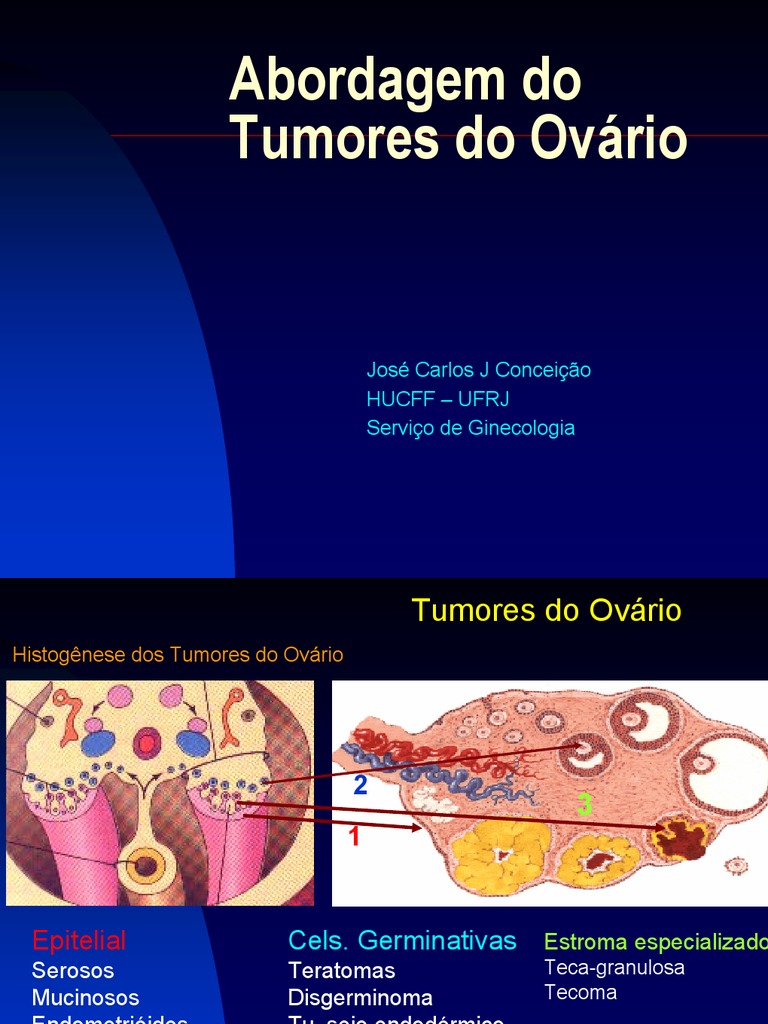 Tumores do Ovário: Classificação e Tratamento | PDF | Câncer de Ovário ...