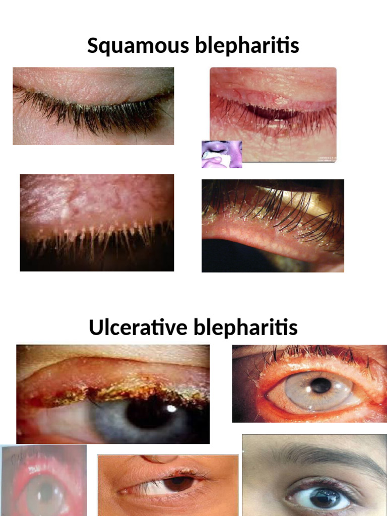 Common Eyelid and Eye Conditions | PDF