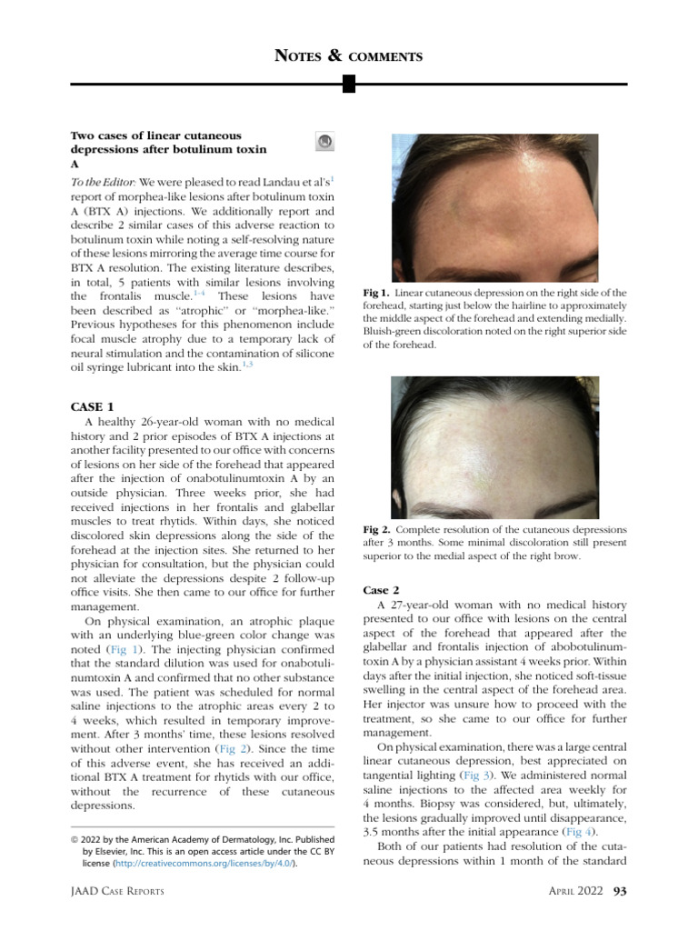B-Tox Frontalis Skin Depressions | PDF | Botulinum Toxin | Medical ...