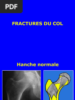 Chapitre 6 - Fractures Du Cotyle | PDF | Orthopédie | Médecine clinique