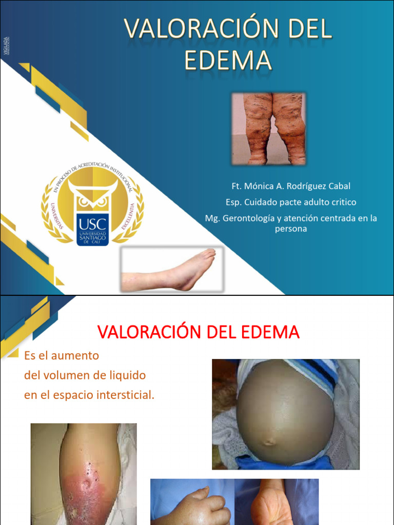 Valoración y Fisiopatología del Edema | PDF | Edema | Especialidades ...