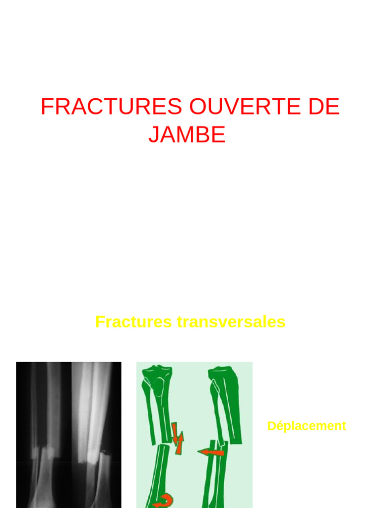 Fractures Ouverte de Jambe | PDF