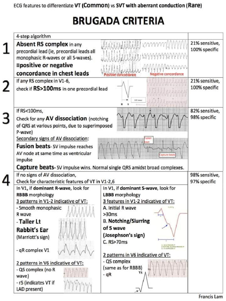 Critérios de Brugada | PDF
