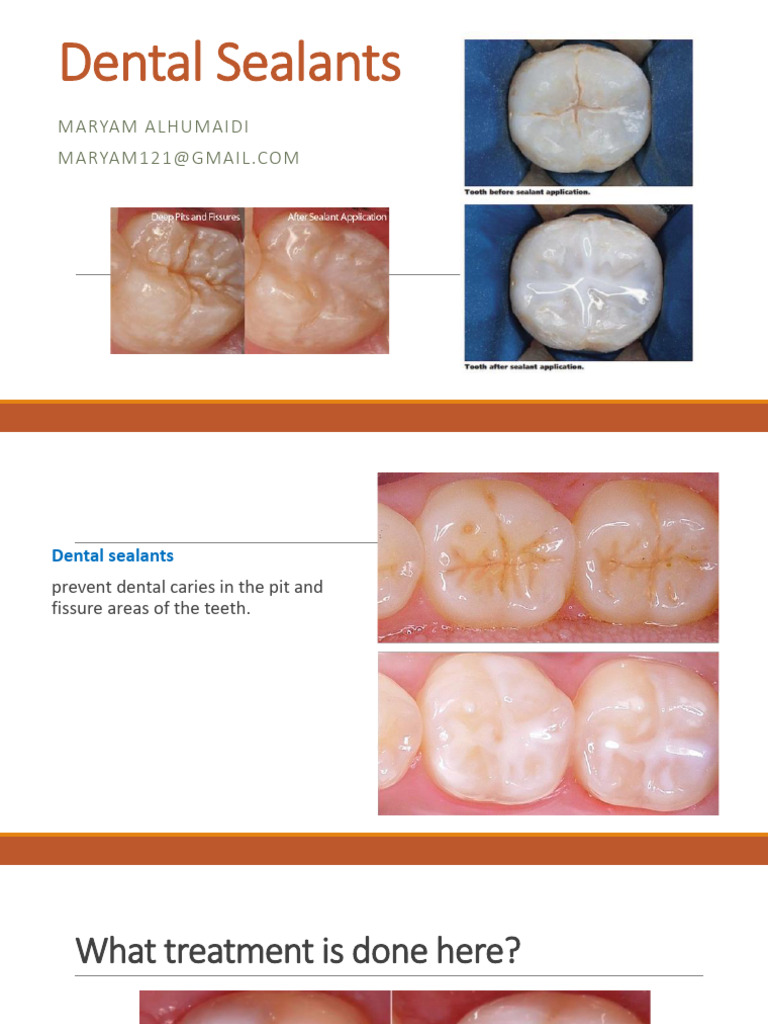 Dental Sealants | PDF