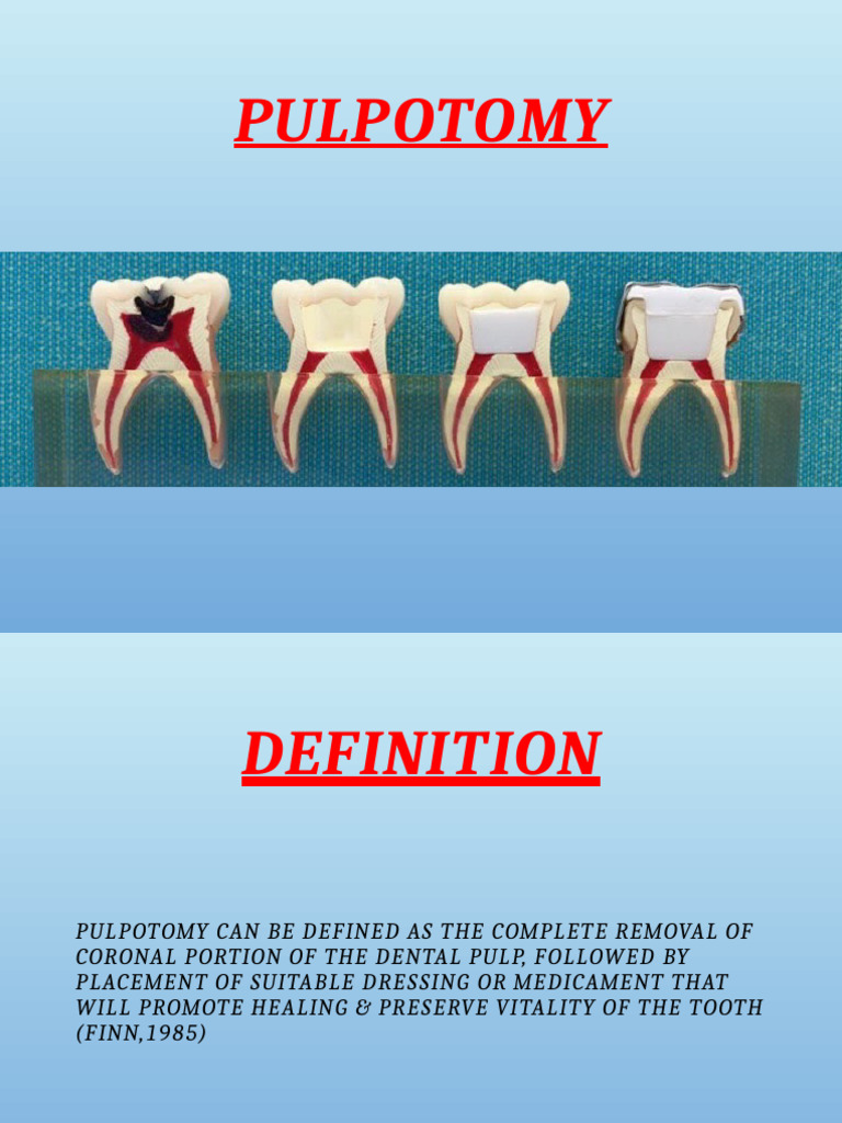 Pulpotomy | PDF | Medical Specialties | Dentistry