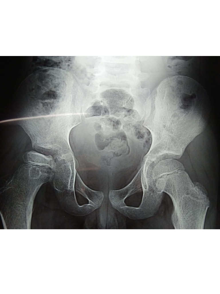 Xray Pelvis Frog Leg View..Tb Hip2308486244413129460 | PDF