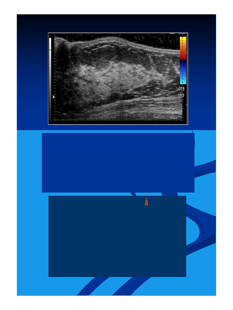 PREMALIGNANT LESIONS ON FBU_Sibiu2010 | PDF | Breast Cancer | Mammography