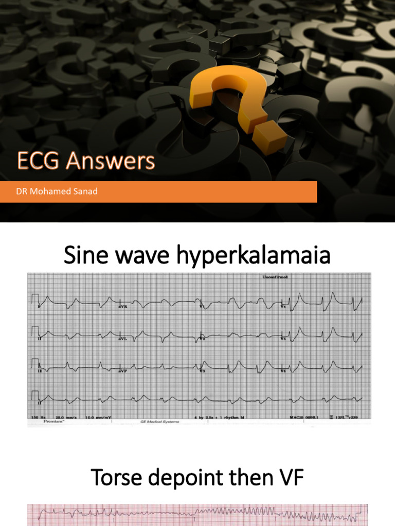 Ecg Answers | PDF
